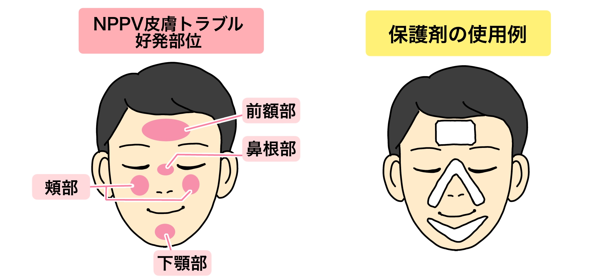 NPPVマスクの種類とトラブル4つと対策方法 - ケアのあるある知恵袋
